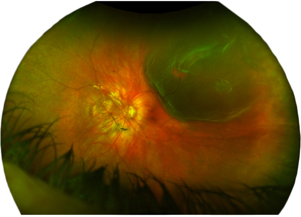 Décollement de la rétine - OphtAlliance
