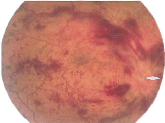 Occlusion veineuse rétinienne - OphtAlliance